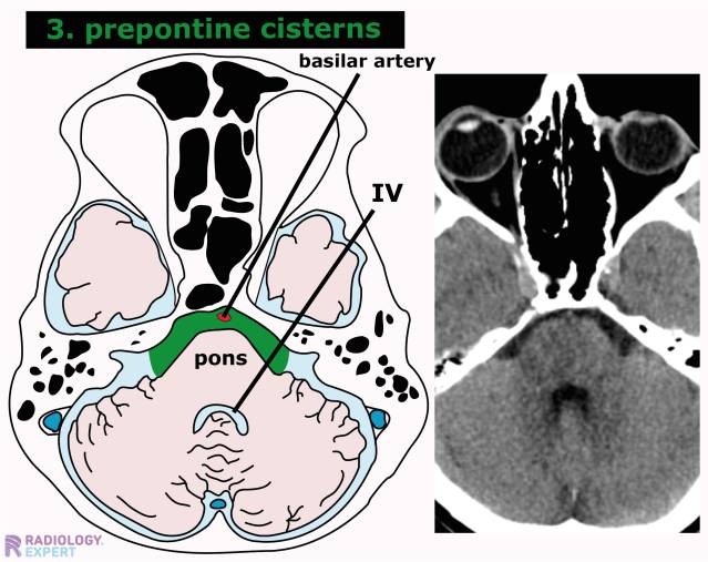 CT brain hemorrhage