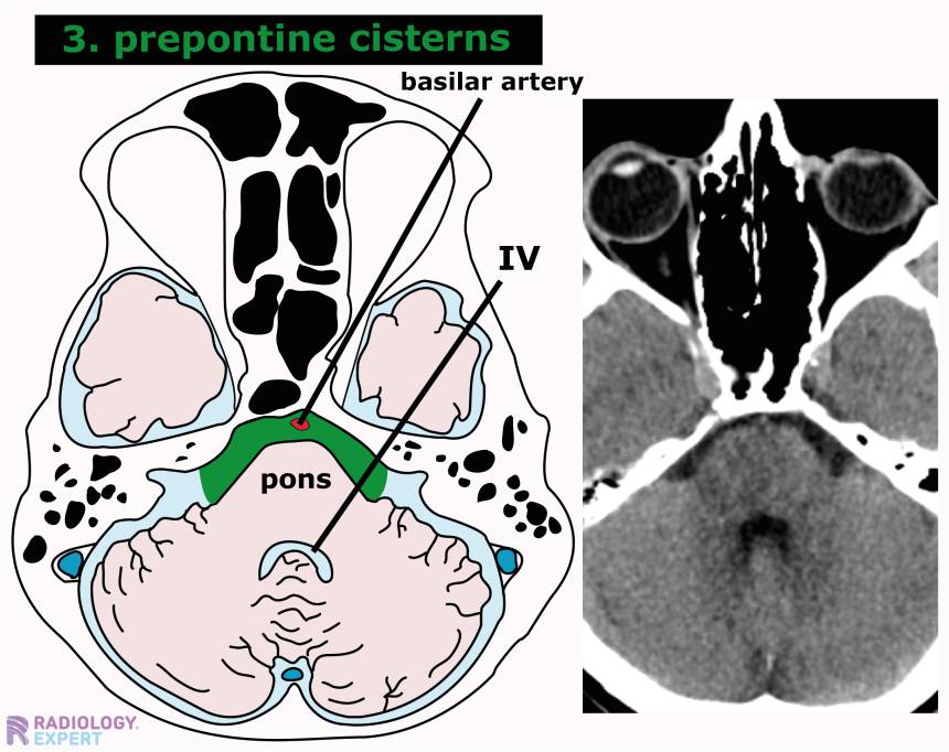 CT brain hemorrhage