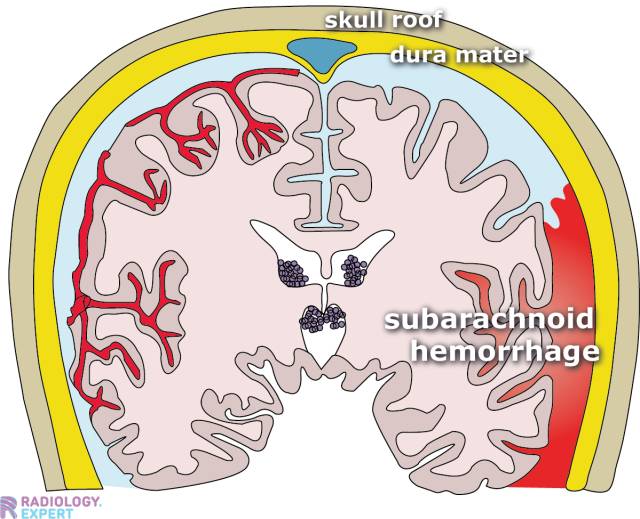 Intracerebral Hemorrhage Vs Subarachnoid Hemorrhage