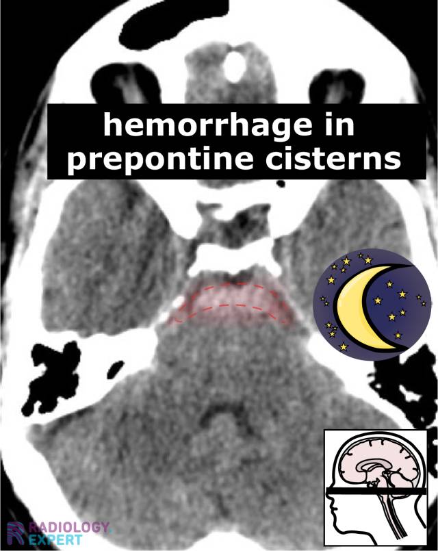 CT brain hemorrhage