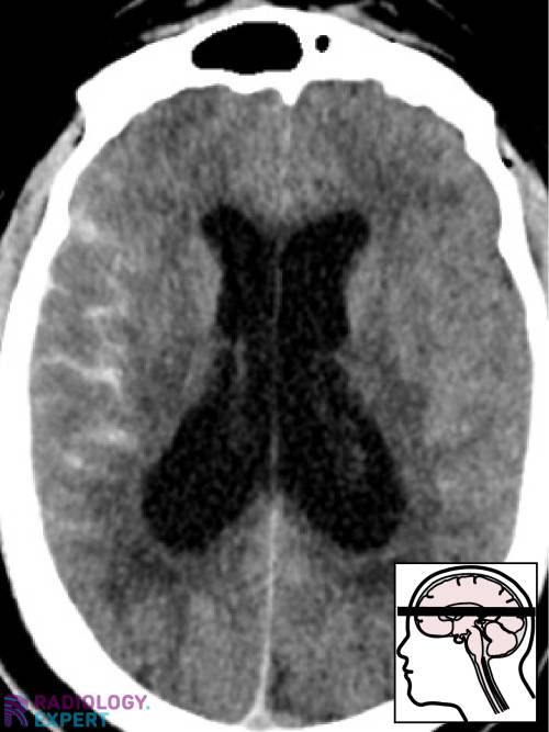 CT brain hemorrhage