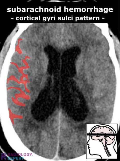CT brain hemorrhage