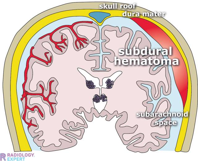 Subdural Hemorrhage Vs Subarachnoid Hemorrhage