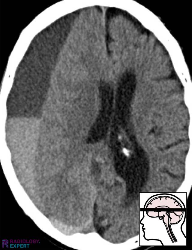 CT brain hemorrhage