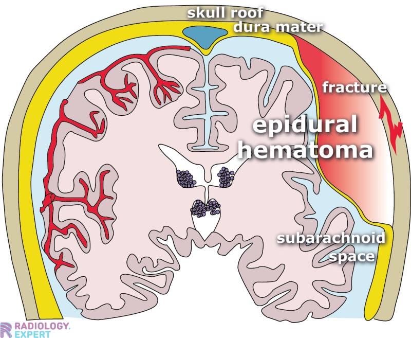 CT brain hemorrhage