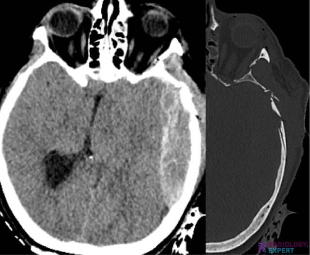 CT brain hemorrhage