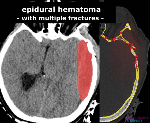 CT brain hemorrhage