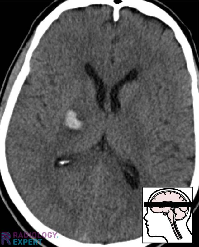 CT brain hemorrhage