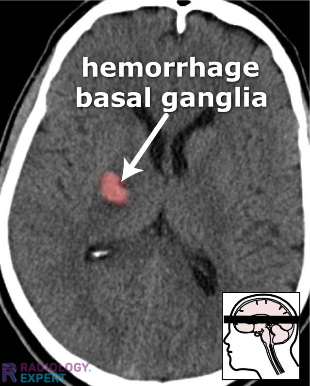 Basal Ganglia Hematoma at Wilbur Pritt blog