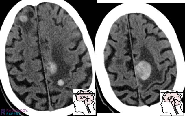 CT brain hemorrhage