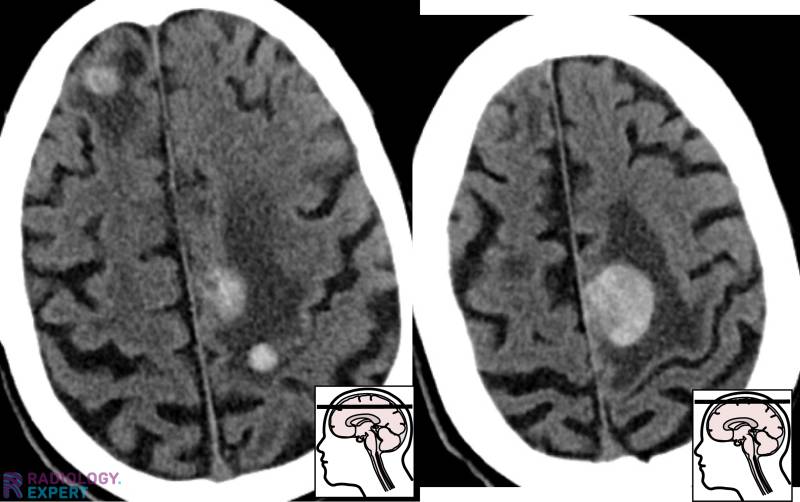 CT brain hemorrhage