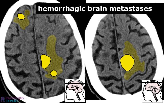 CT brain hemorrhage