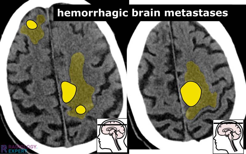 CT brain hemorrhage