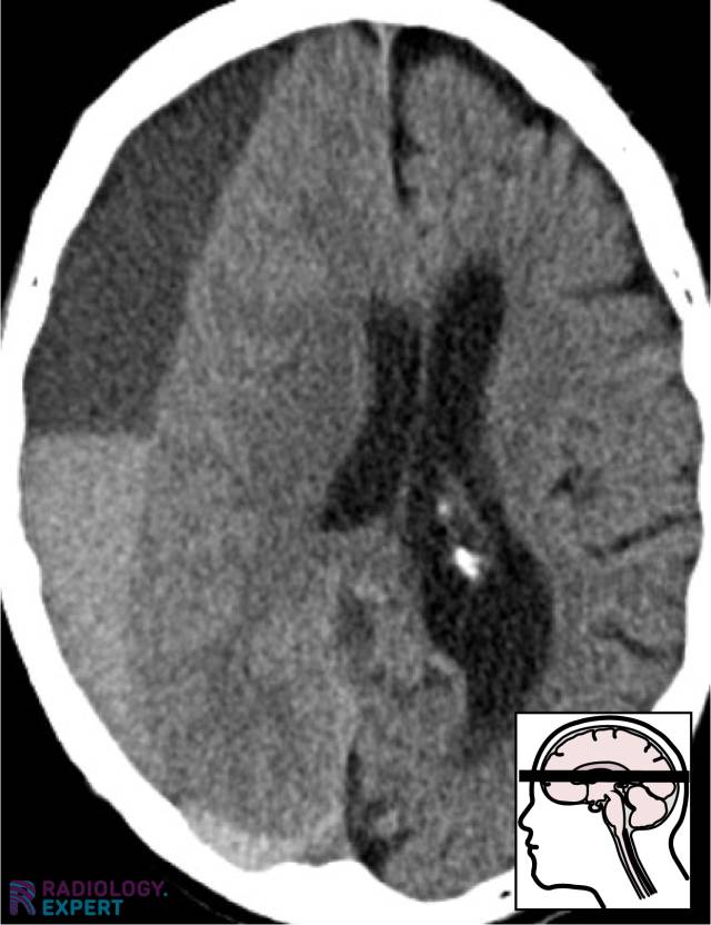 CT brain hemorrhage