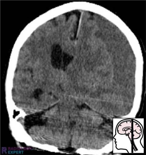 CT brain hemorrhage