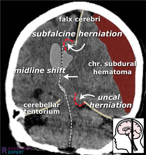 CT brain hemorrhage