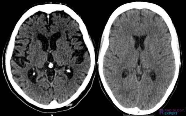 CT brain hemorrhage