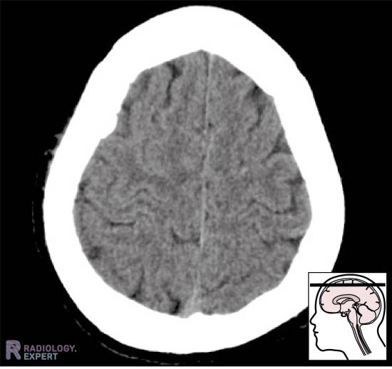 CT hersenen bloeding