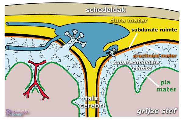 CT hersenen bloeding