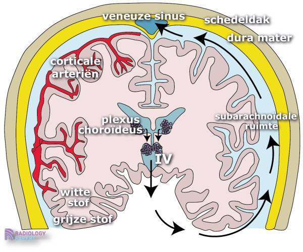 CT hersenen bloeding