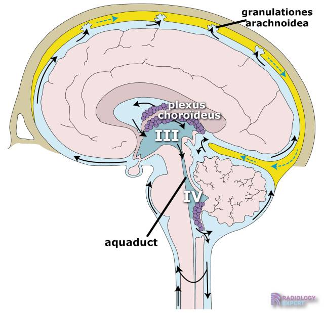 CT hersenen bloeding