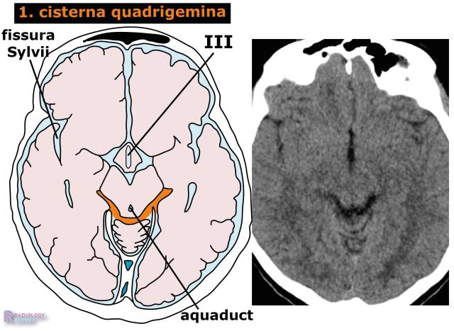CT hersenen bloeding