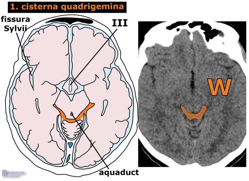 CT hersenen bloeding
