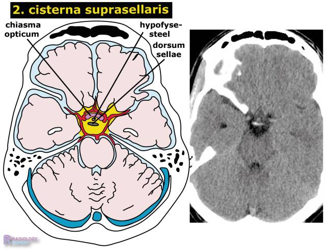 CT hersenen bloeding