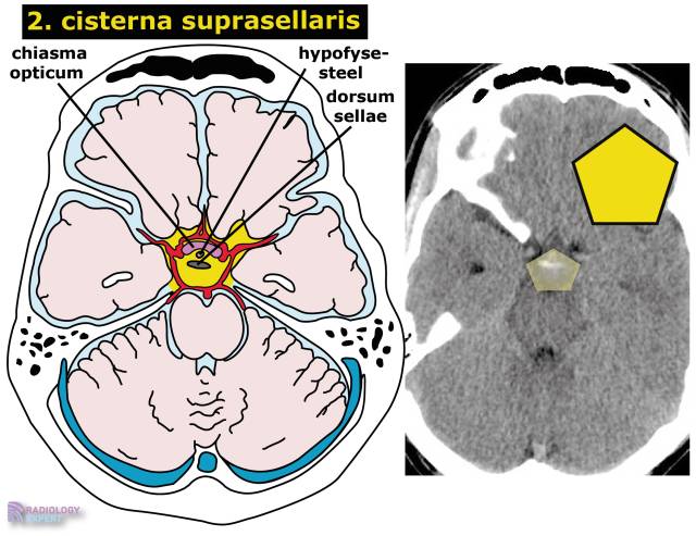 CT hersenen bloeding