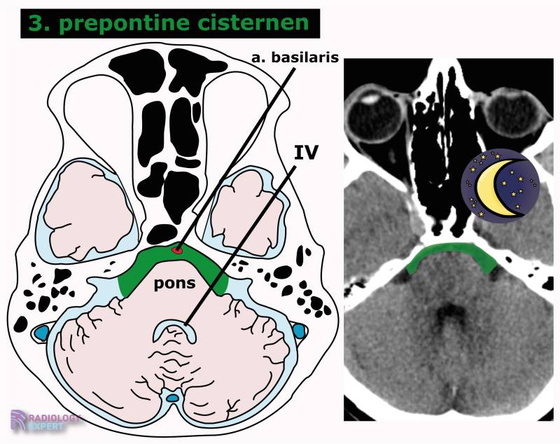 CT hersenen bloeding