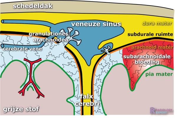 CT hersenen bloeding
