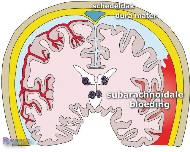 CT hersenen bloeding