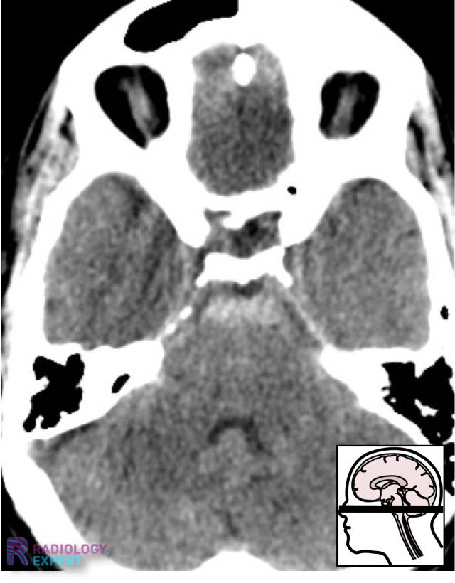 CT hersenen bloeding