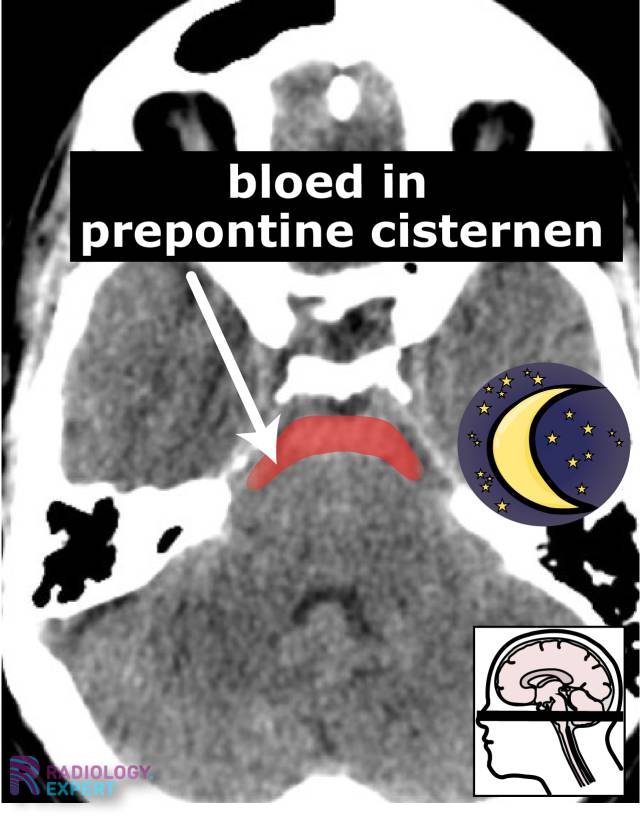 CT hersenen bloeding