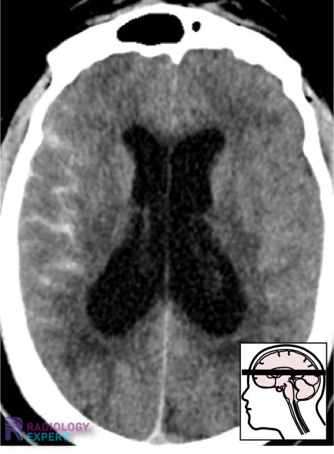 CT hersenen bloeding