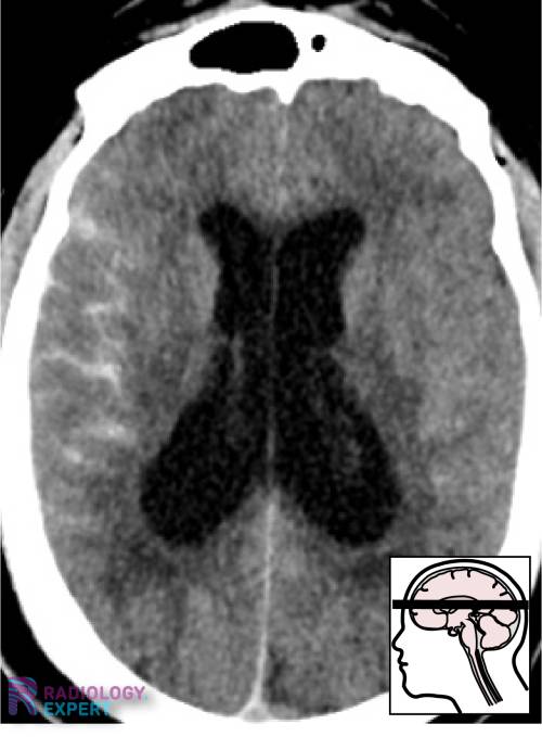 CT hersenen bloeding