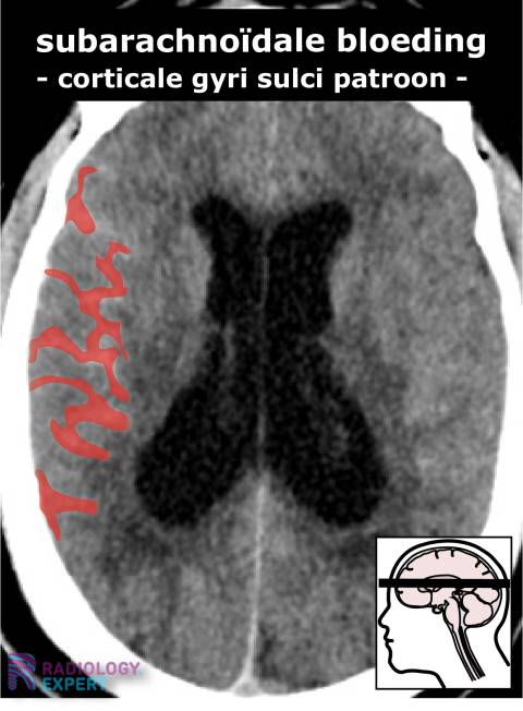 CT hersenen bloeding