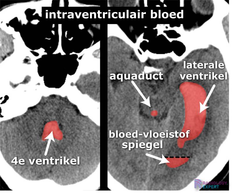 CT hersenen bloeding