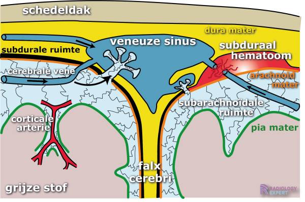 CT hersenen bloeding