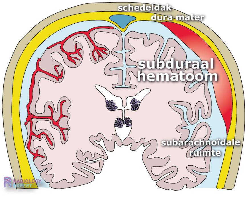 CT hersenen bloeding