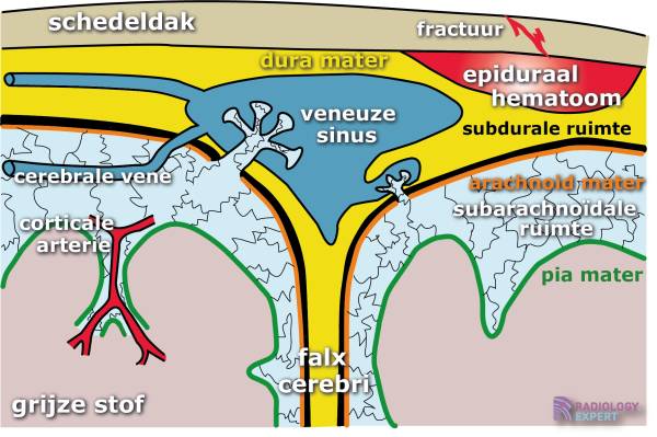 CT hersenen bloeding