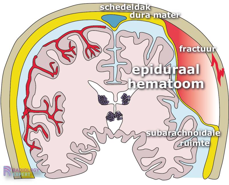 CT hersenen bloeding