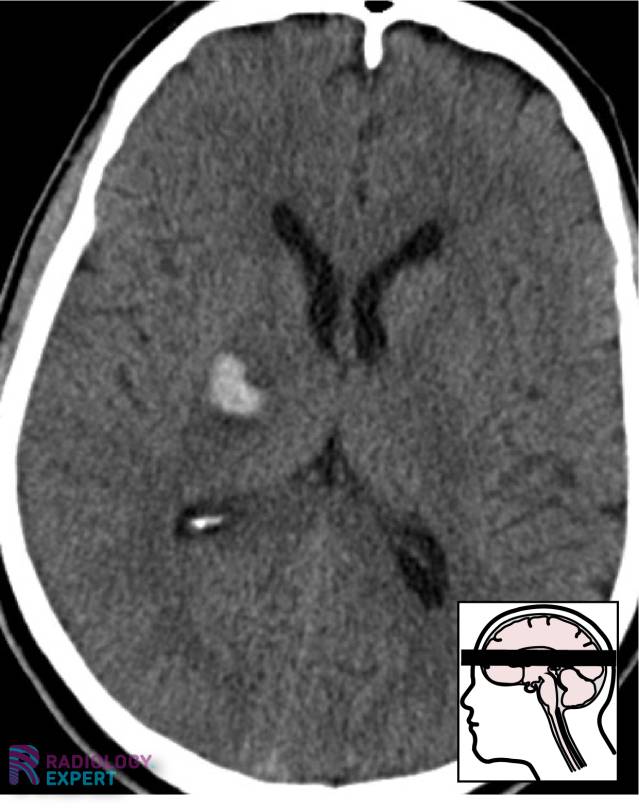 CT hersenen bloeding