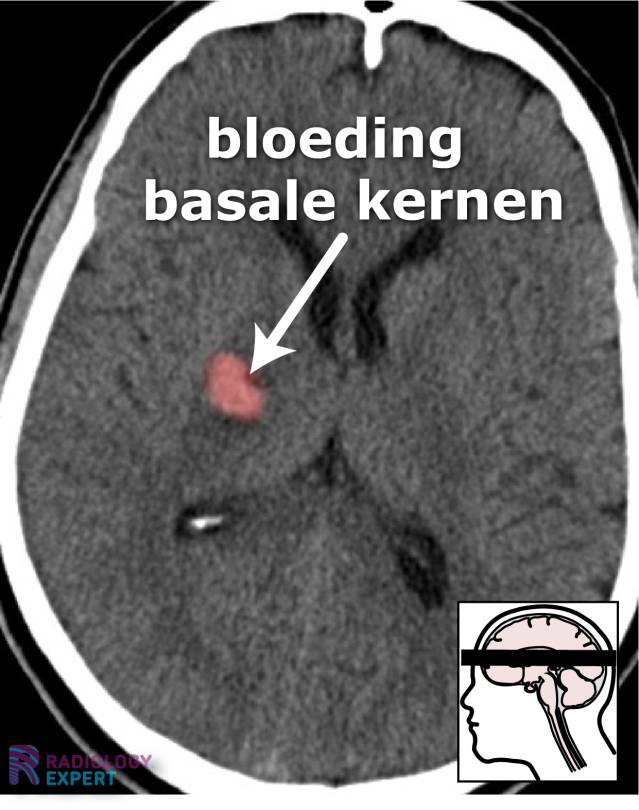 CT hersenen bloeding