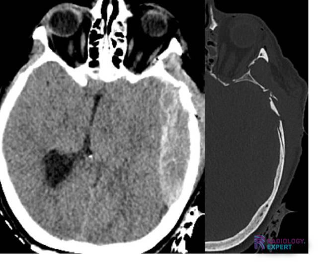 CT hersenen bloeding