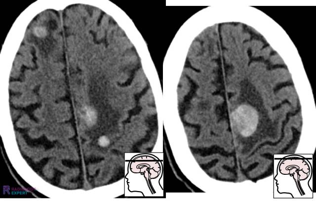 CT hersenen bloeding
