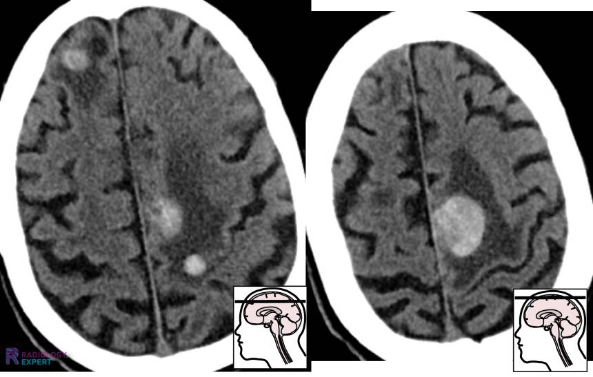 CT hersenen bloeding