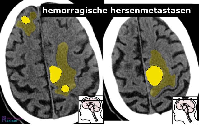 CT hersenen bloeding