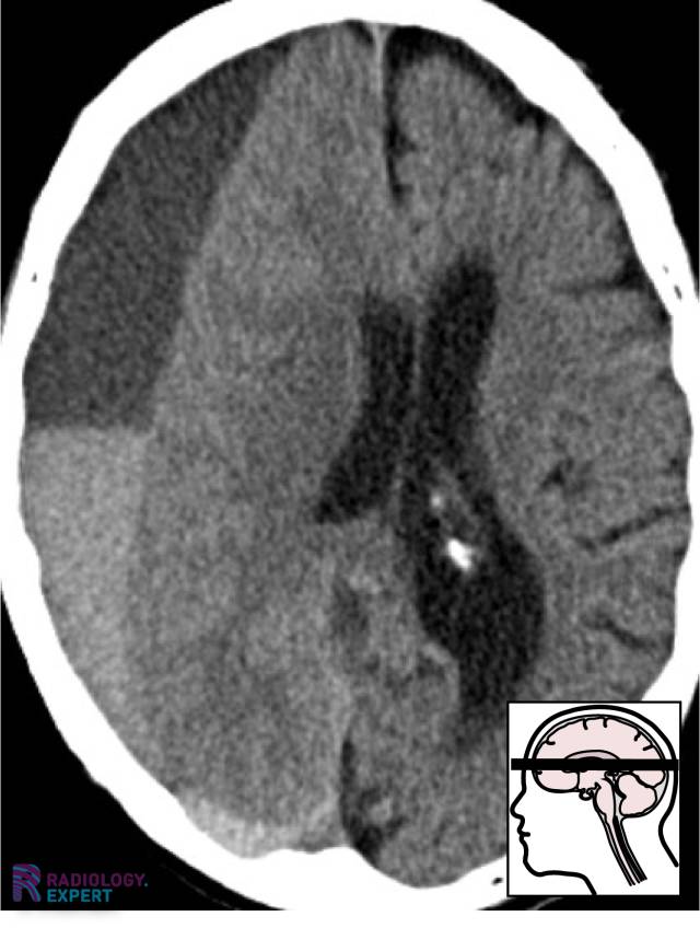 CT hersenen bloeding
