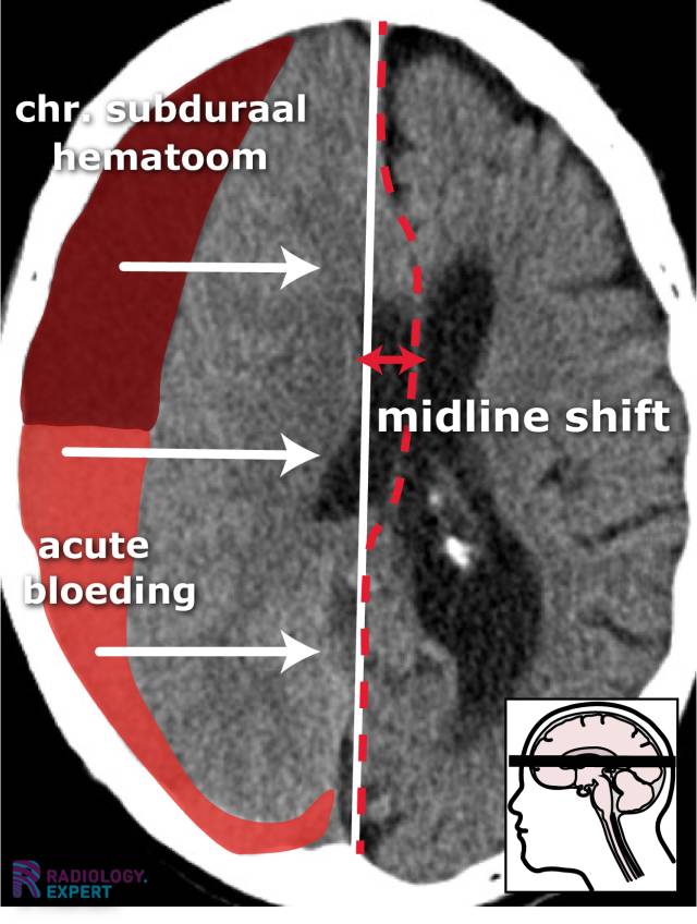CT hersenen bloeding